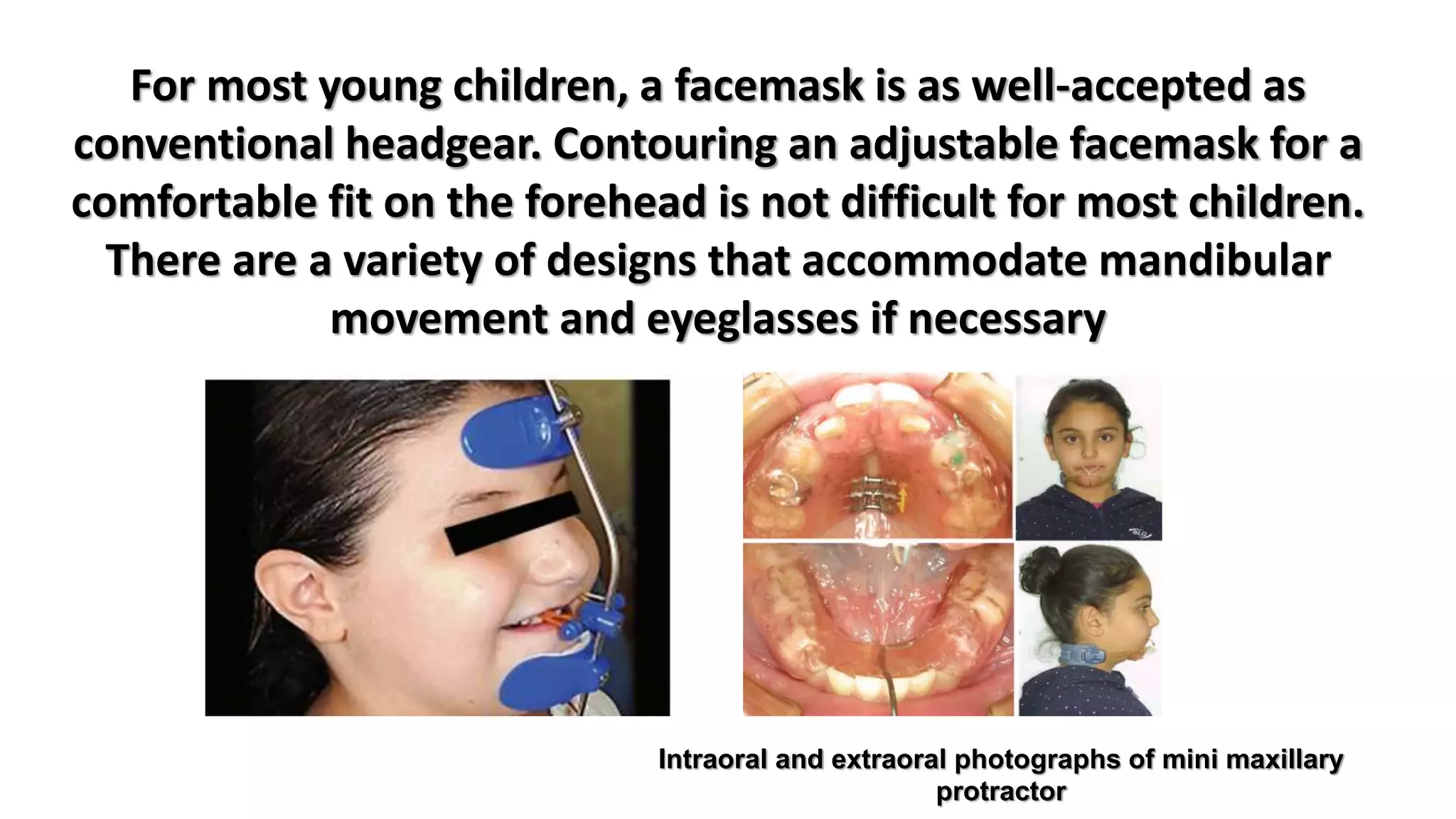 Orthopedic protraction of the maxilla part 1 | PPTX