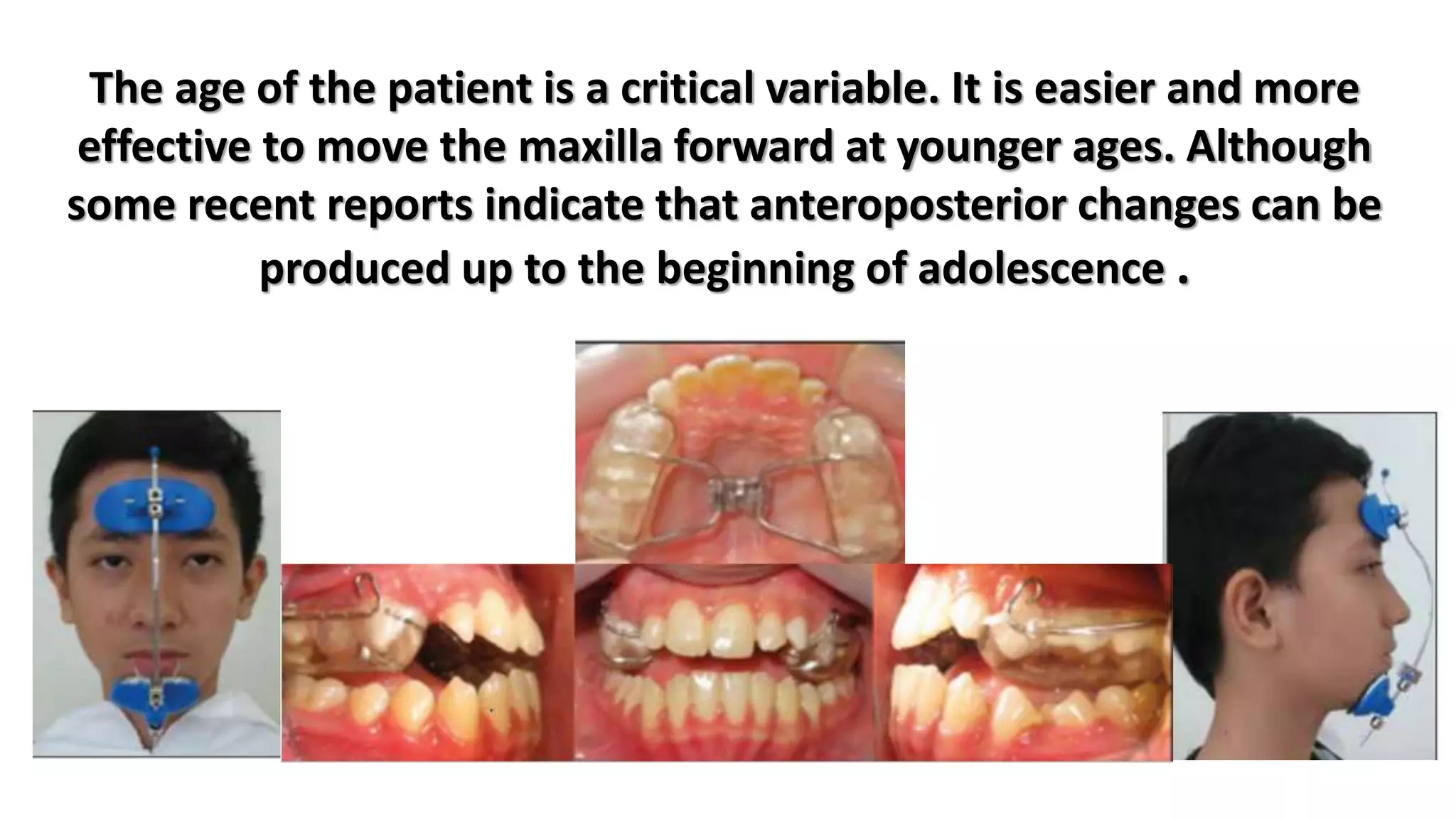 Orthopedic protraction of the maxilla part 1 | PPTX | Oral care | Personal Care