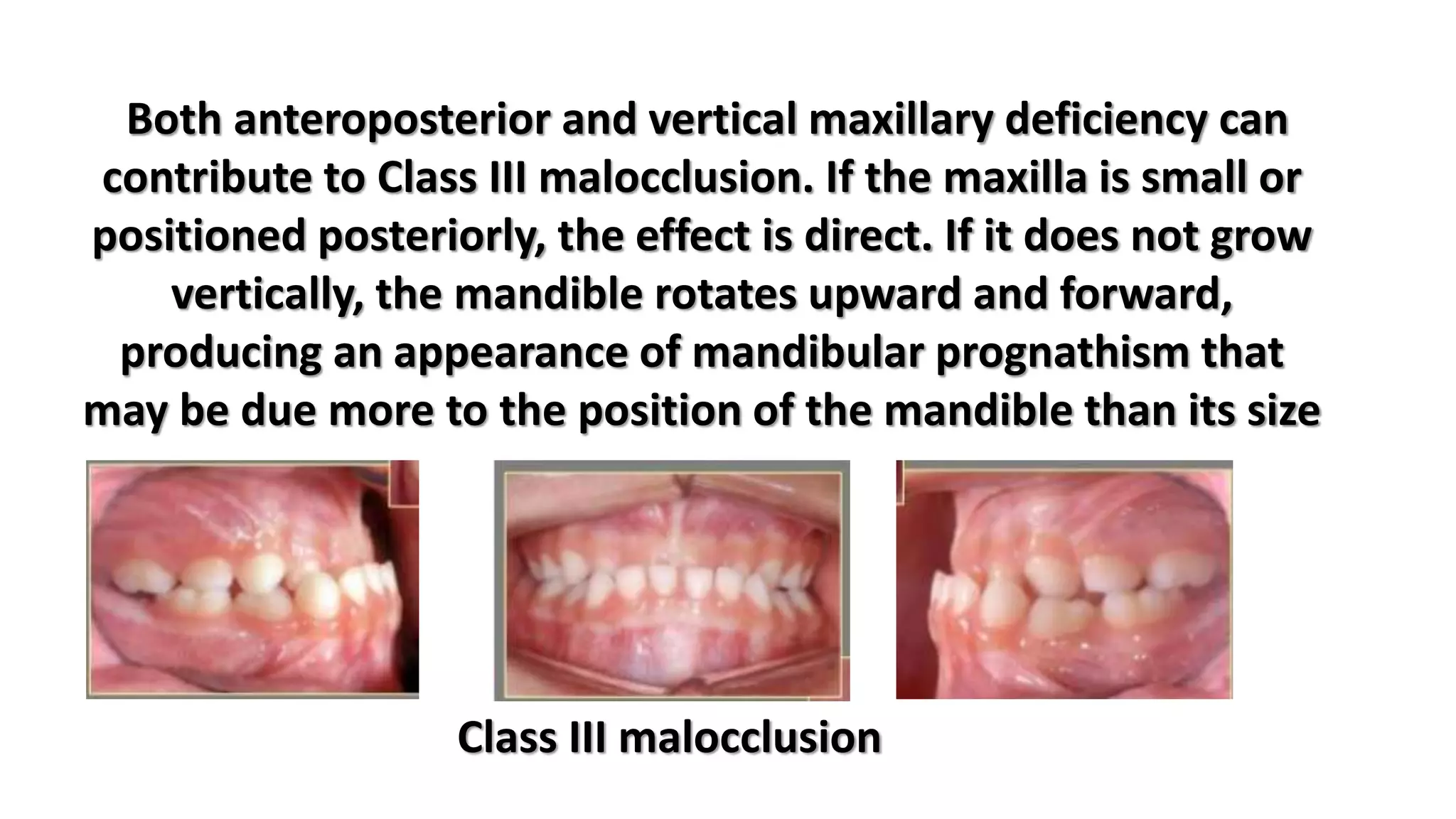 Orthopedic protraction of the maxilla part 1 | PPTX