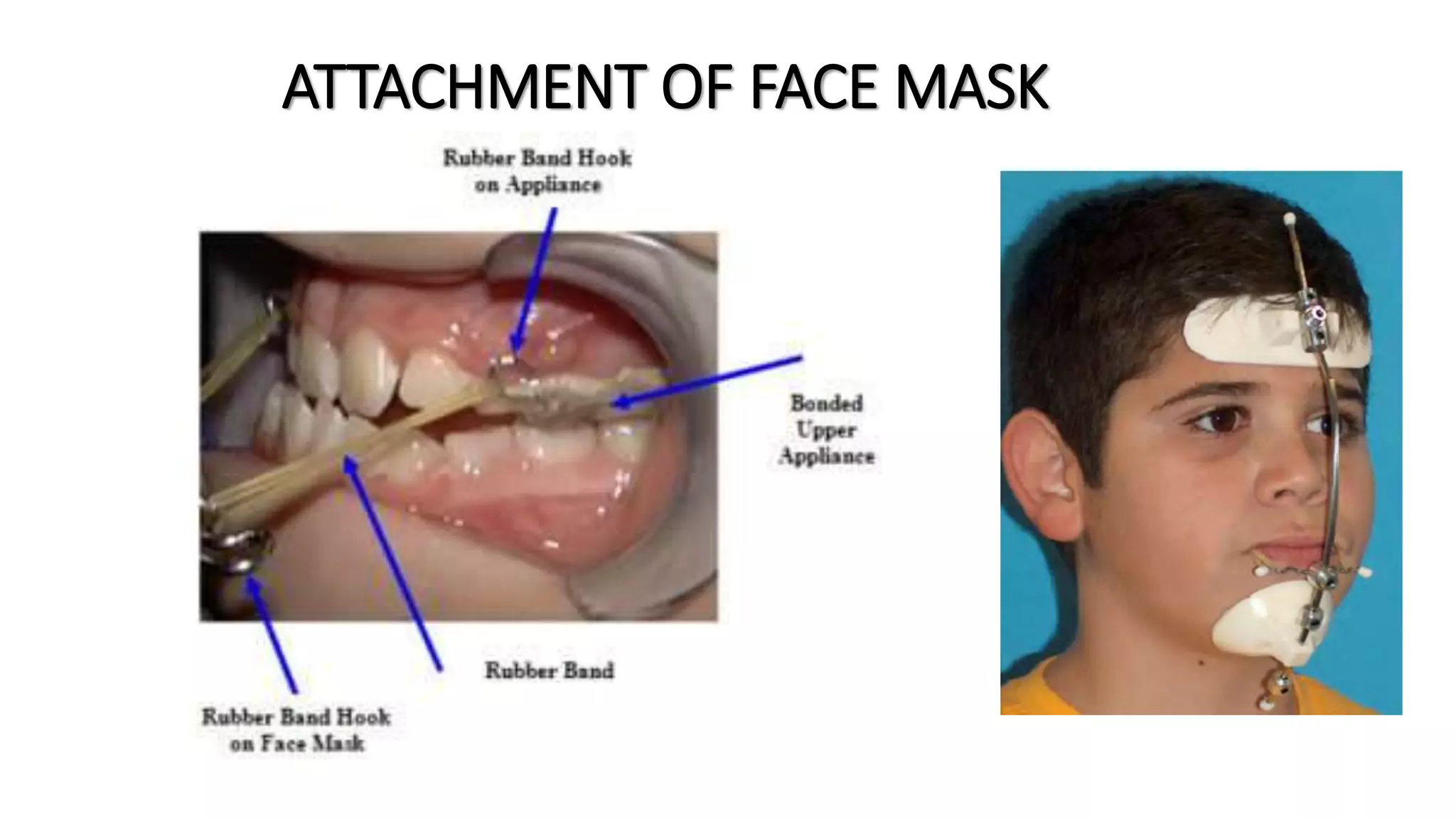Orthopedic protraction of the maxilla part 1 | PPTX