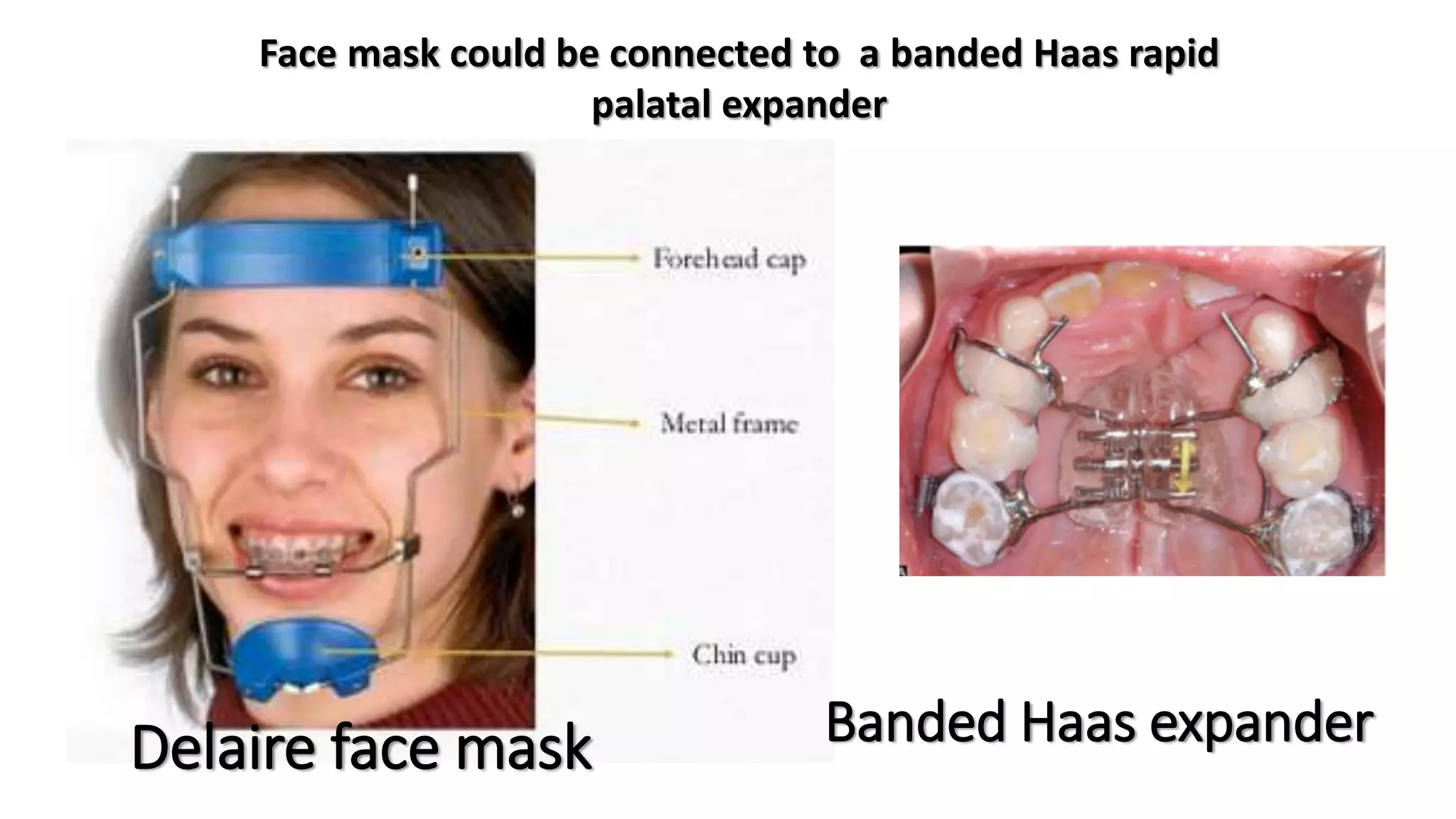 Orthopedic protraction of the maxilla part 1 | PPTX