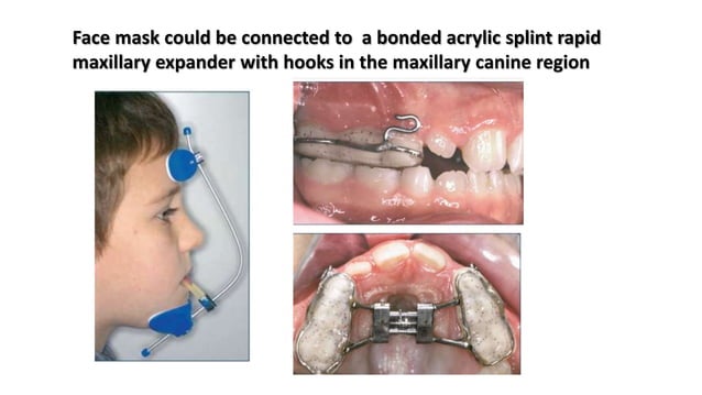 Orthopedic protraction of the maxilla part 1 | PPTX | Oral care | Personal Care
