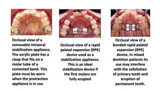 Orthopedic protraction of the maxilla part 1 | PPTX
