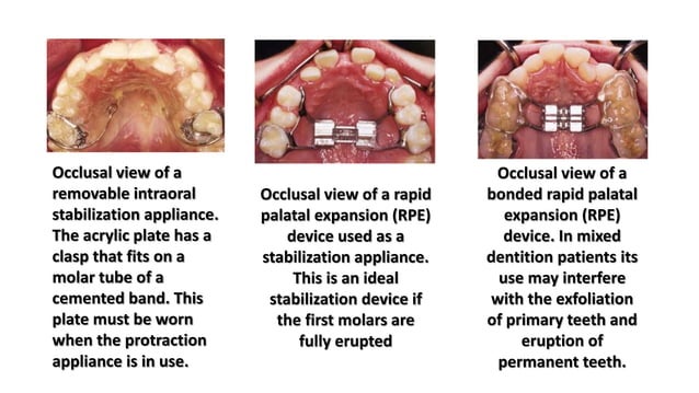 Orthopedic protraction of the maxilla part 1 | PPTX | Oral care ...