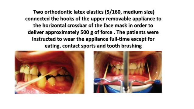 Orthopedic protraction of the maxilla part 1 | PPTX | Oral care | Personal Care