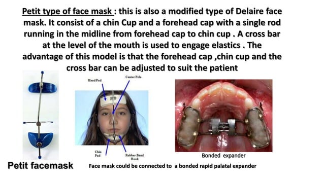 Orthopedic protraction of the maxilla part 1 | PPTX | Oral care | Personal Care