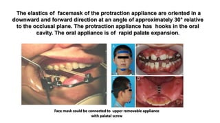 Orthopedic protraction of the maxilla part 1 | PPTX