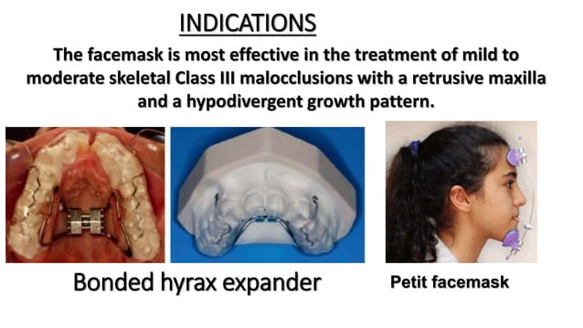 Orthopedic protraction of the maxilla part 1 | PPTX | Oral care ...