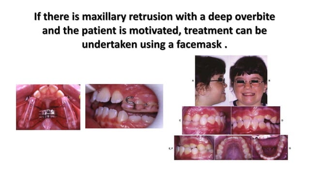 Orthopedic protraction of the maxilla part 1 | PPTX | Oral care ...