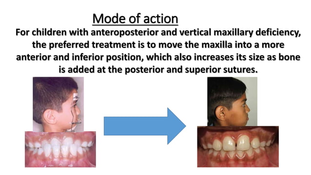 Orthopedic protraction of the maxilla part 1 | PPTX | Oral care | Personal Care