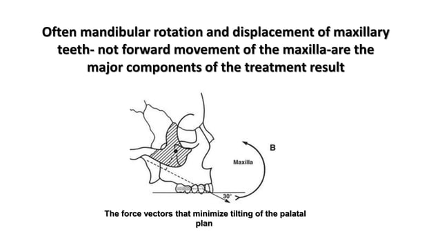 Orthopedic protraction of the maxilla part 1 | PPTX | Oral care ...