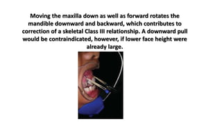 Orthopedic protraction of the maxilla part 1 | PPTX