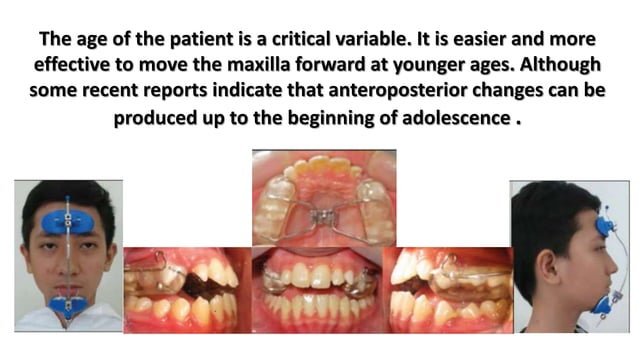 Orthopedic protraction of the maxilla part 1 | PPTX | Oral care ...