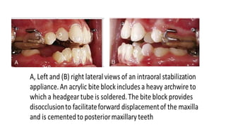 Orthopedic protraction of the maxilla part 1 | PPTX