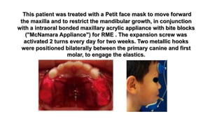 Orthopedic protraction of the maxilla part 1 | PPTX