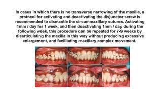 Orthopedic protraction of the maxilla part 1 | PPTX