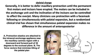 Orthopedic protraction of the maxilla part 1 | PPTX