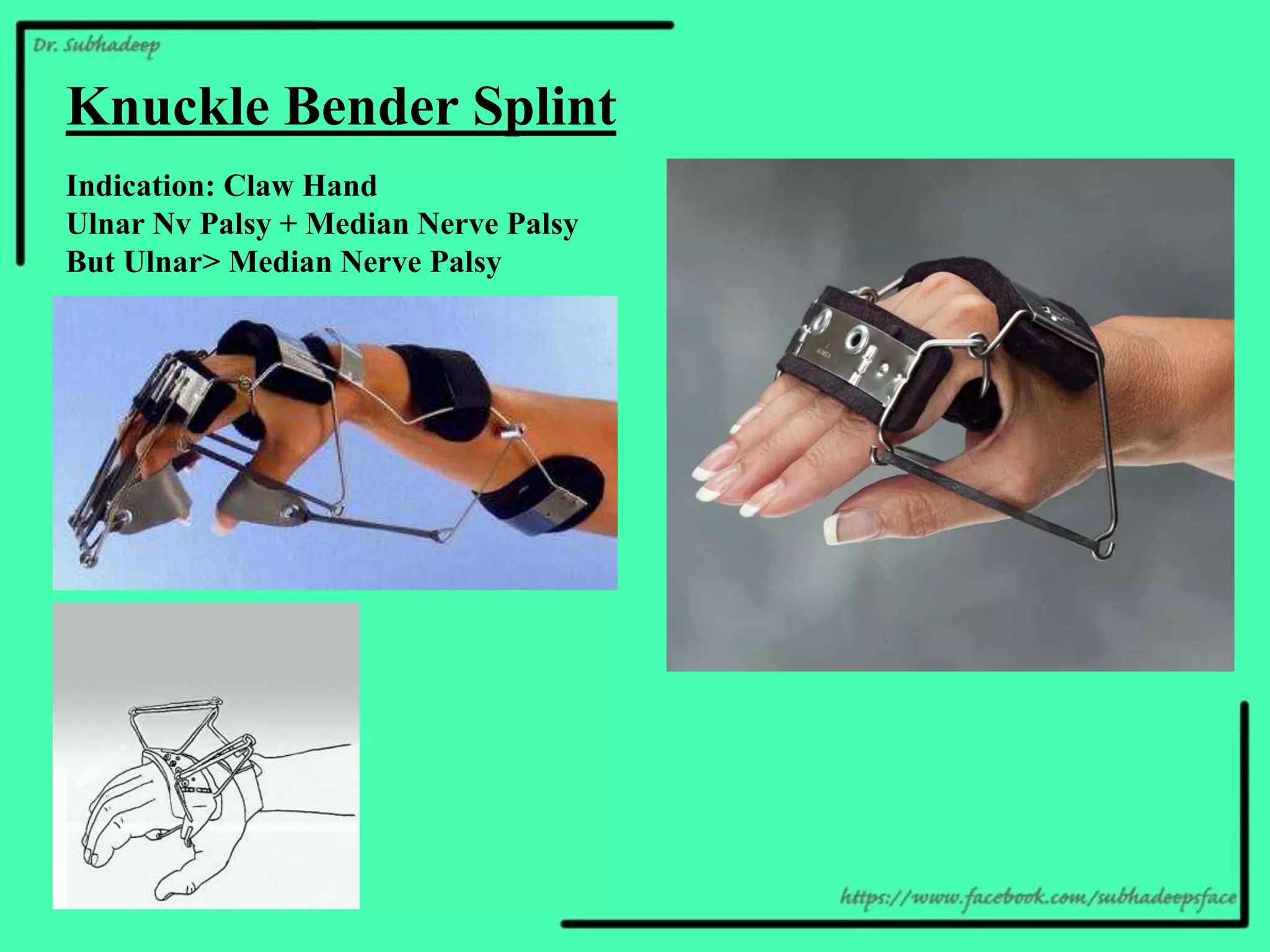 Orthopedic Splints and Casts- Subhadeep PGModules.pptx