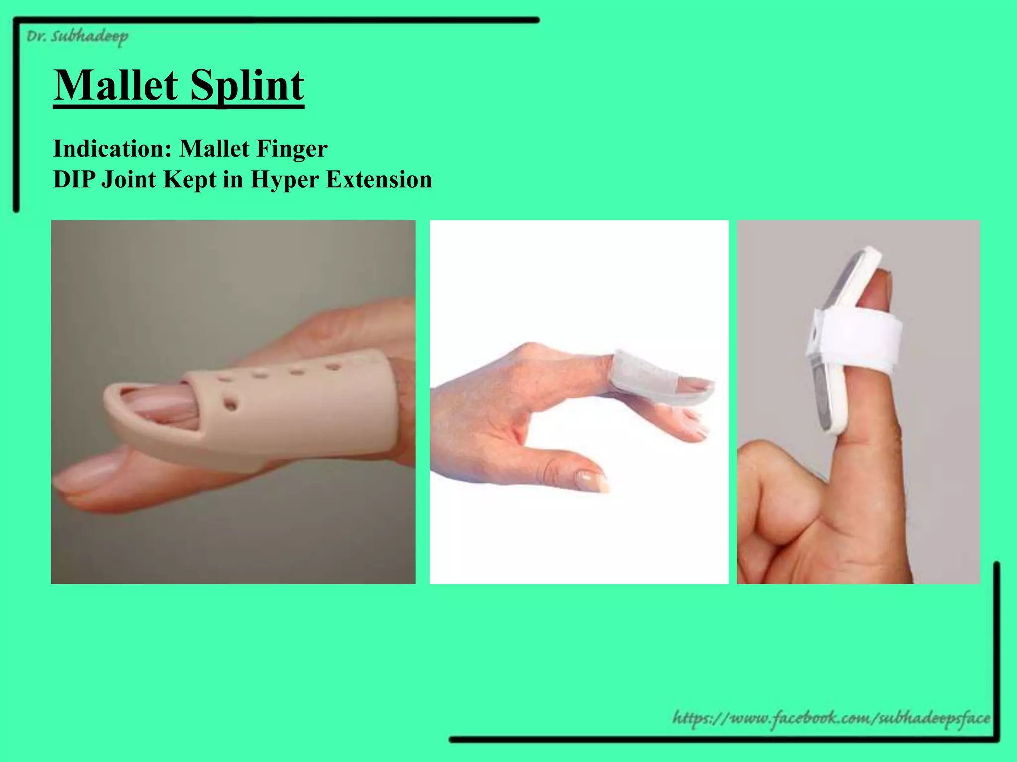 Orthopedic Splints and Casts- Subhadeep PGModules.pptx