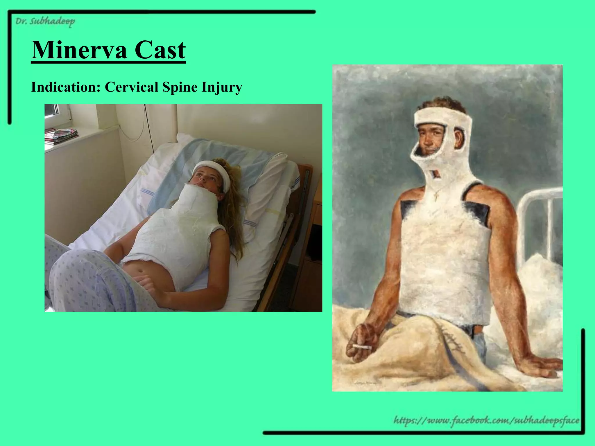 Orthopedic Splints and Casts- Subhadeep PGModules.pptx