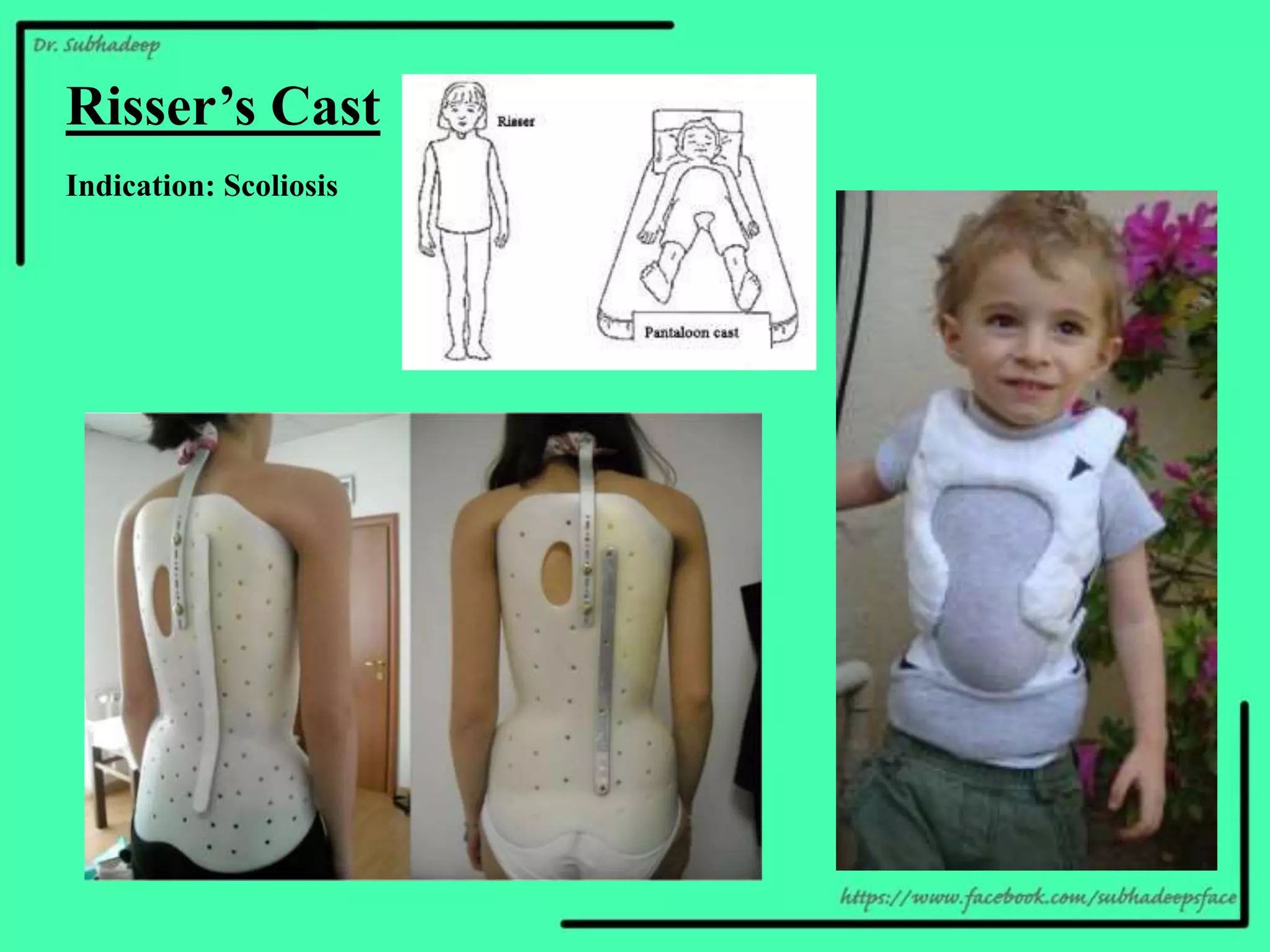 Orthopedic Splints and Casts- Subhadeep PGModules.pptx