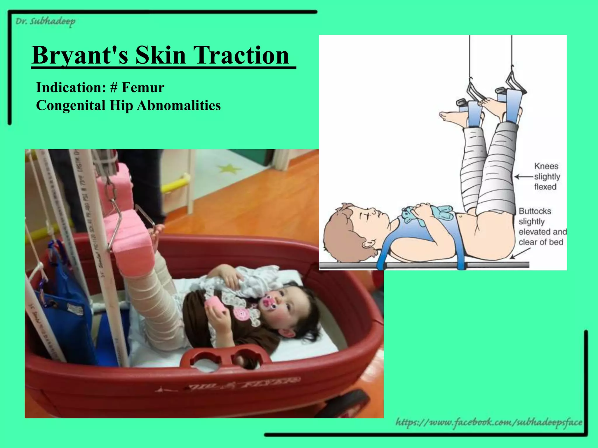 Orthopedic Splints and Casts- Subhadeep PGModules.pptx