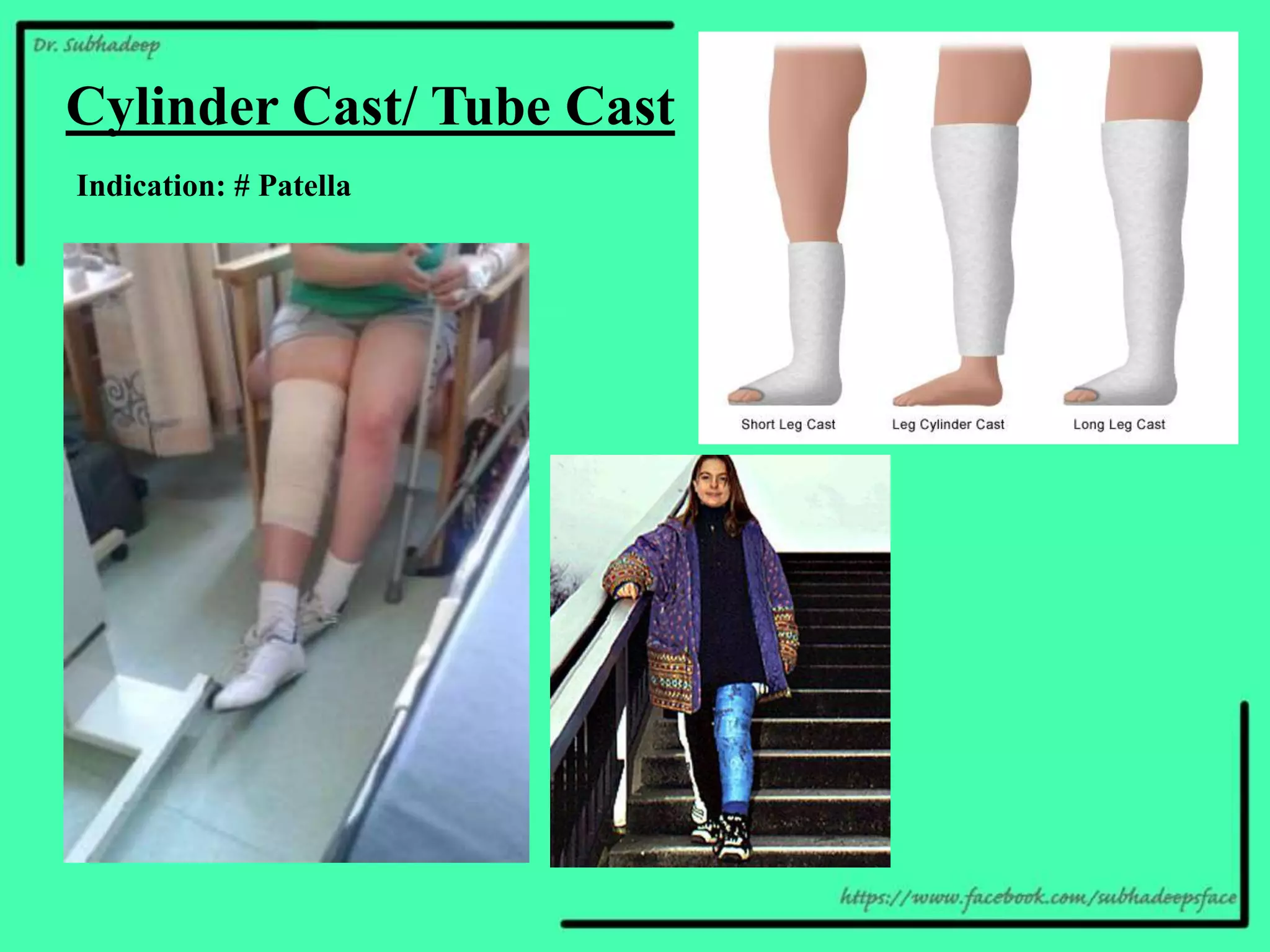 Orthopedic Splints and Casts- Subhadeep PGModules.pptx