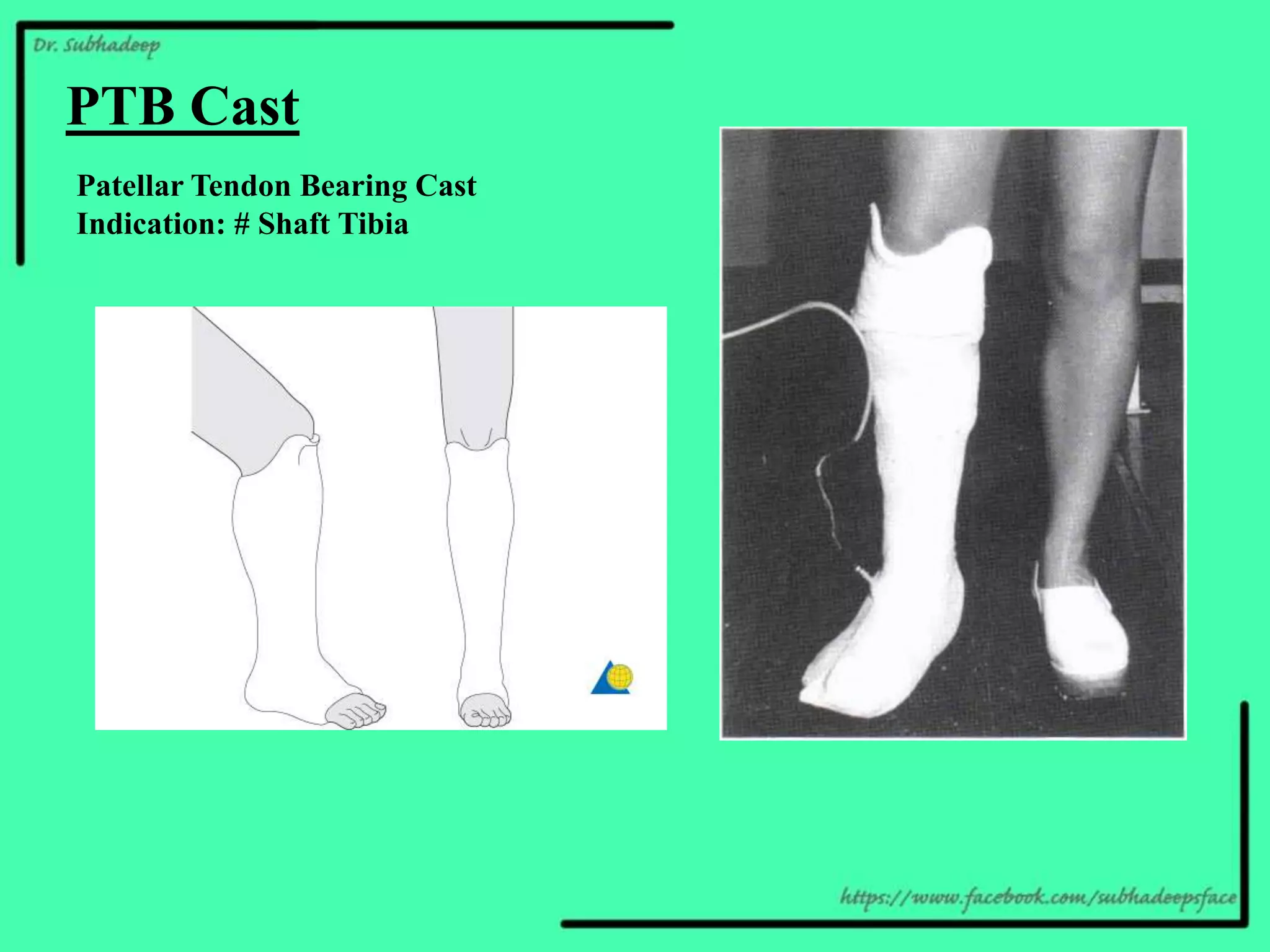 Orthopedic Splints and Casts- Subhadeep PGModules.pptx