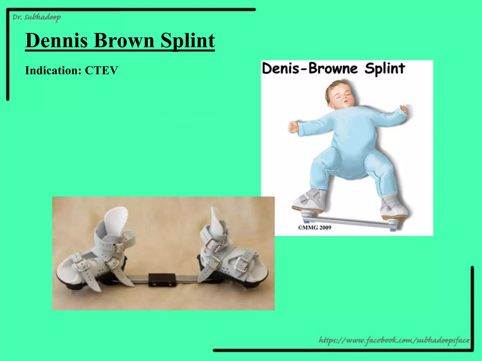 Orthopedic Splints and Casts- Subhadeep PGModules.pptx