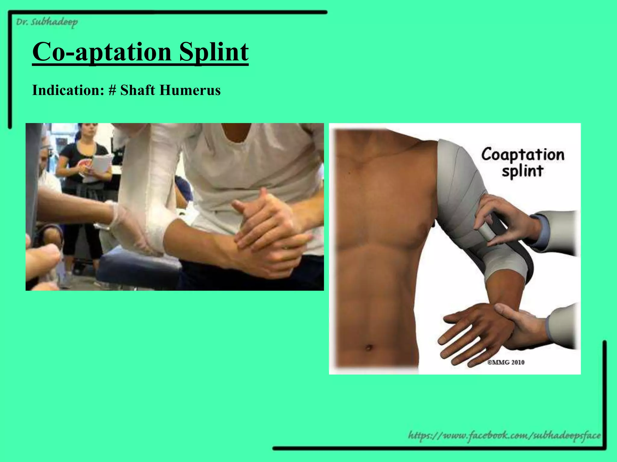 Orthopedic Splints and Casts- Subhadeep PGModules.pptx