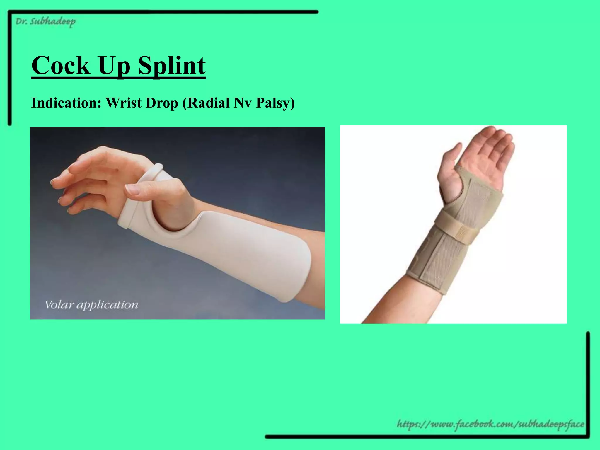 Orthopedic Splints and Casts- Subhadeep PGModules.pptx