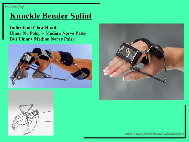Orthopedic Splints and Casts- Subhadeep PGModules.pptx | Death, Injury ...