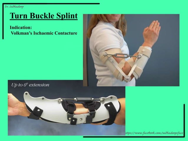 Orthopedic Splints and Casts- Subhadeep PGModules.pptx | Death, Injury ...