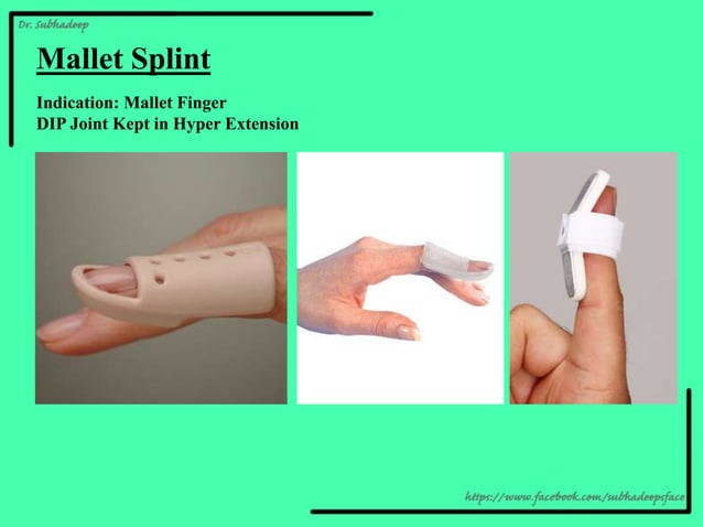 Orthopedic Splints and Casts- Subhadeep PGModules.pptx | Death, Injury, or Military Conflict ...