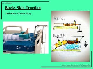 Orthopedic Splints and Casts- Subhadeep PGModules.pptx