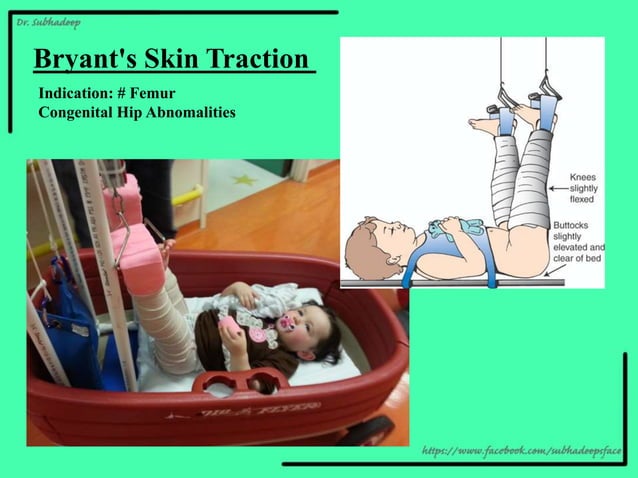 Orthopedic Splints and Casts- Subhadeep PGModules.pptx | Death, Injury ...