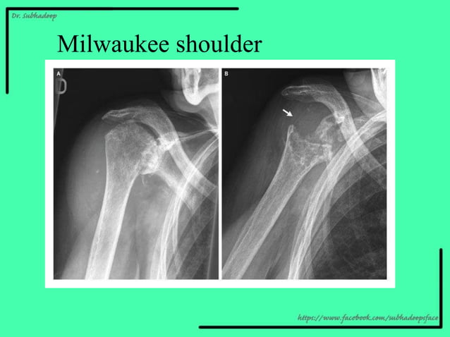 Orthopedic Splints and Casts- Subhadeep PGModules.pptx | Death, Injury ...