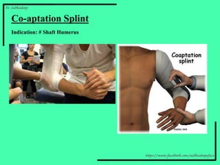 Orthopedic Splints and Casts- Subhadeep PGModules.pptx
