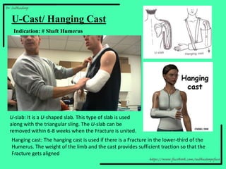 Orthopedic Splints and Casts- Subhadeep PGModules.pptx