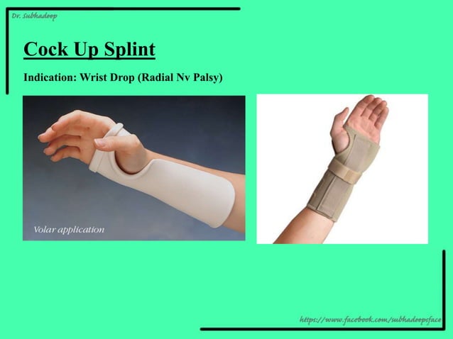 Orthopedic Splints and Casts- Subhadeep PGModules.pptx | Death, Injury ...