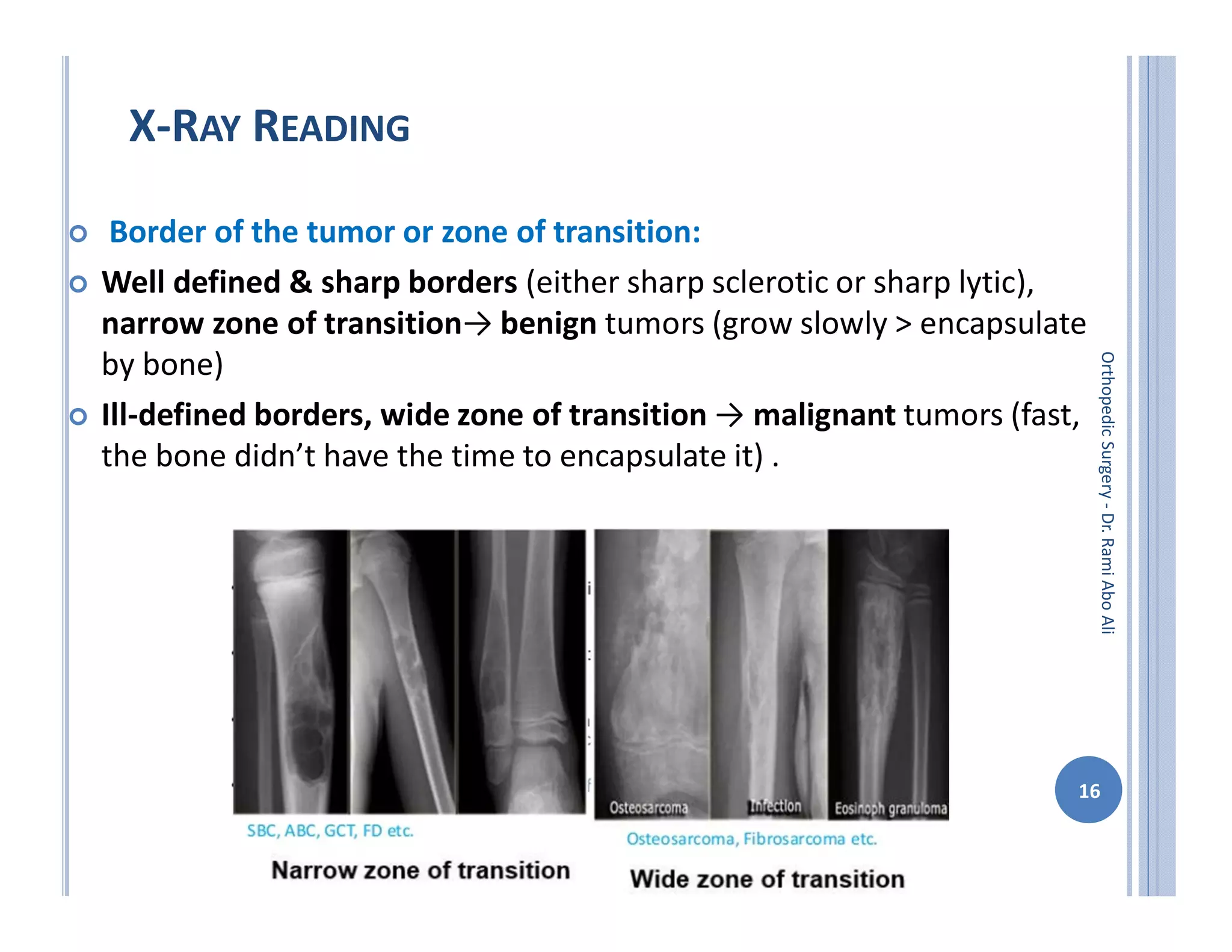 Orthopedic surgery 11th bone tumors | PDF