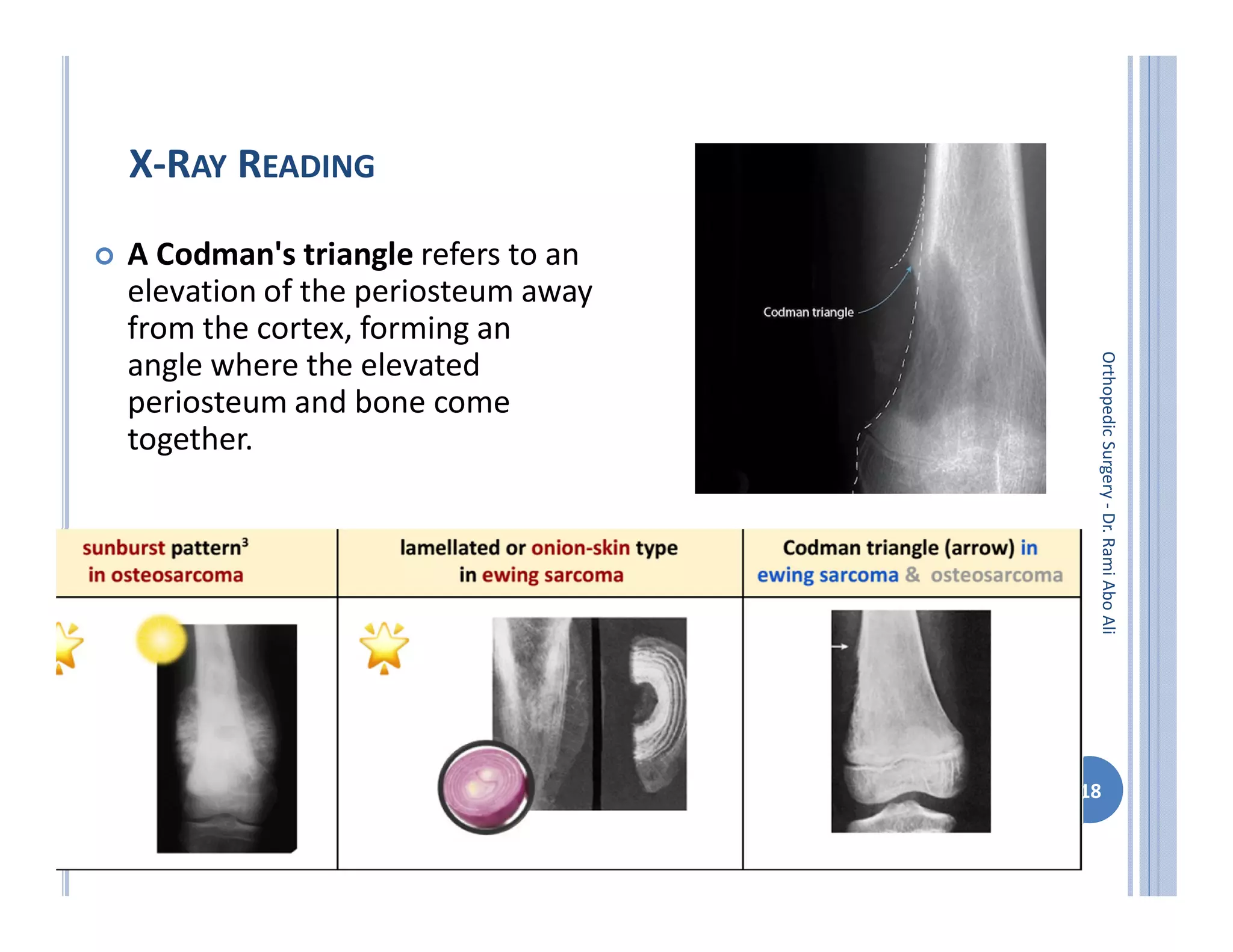 Orthopedic surgery 11th bone tumors | PDF
