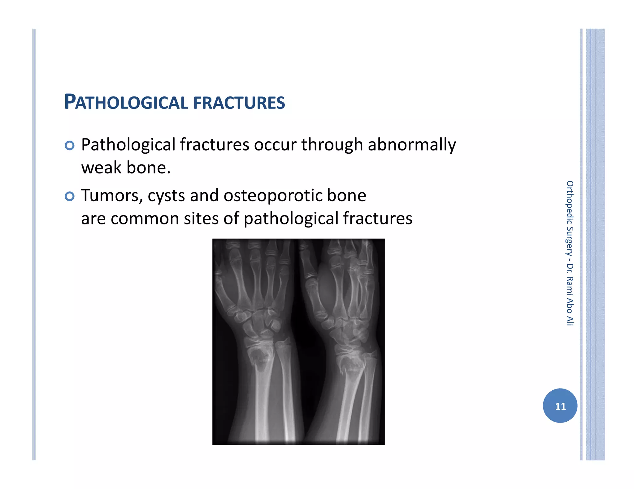 Orthopedic surgery 2nd general principles in fractures | PDF