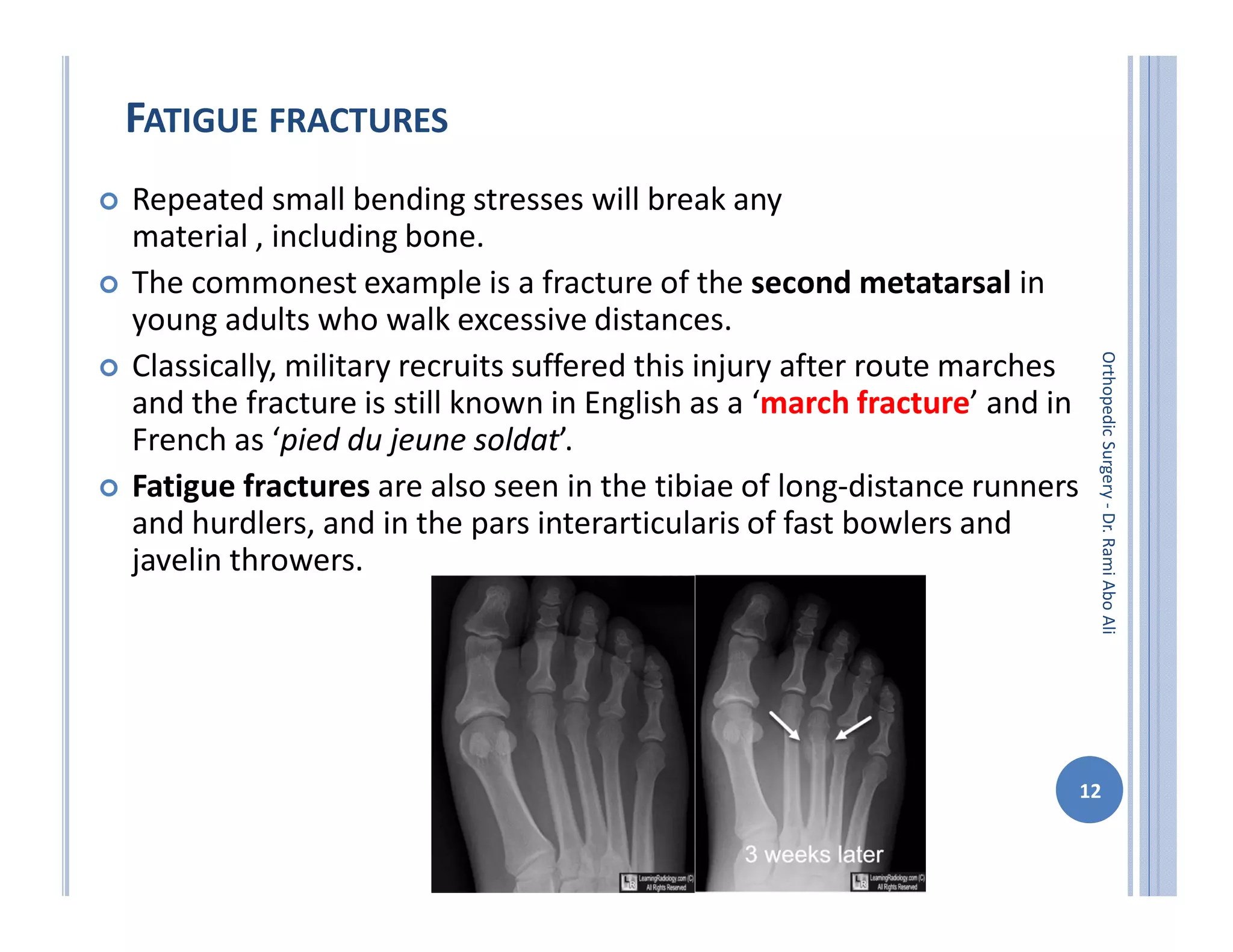 Orthopedic surgery 2nd general principles in fractures | PDF