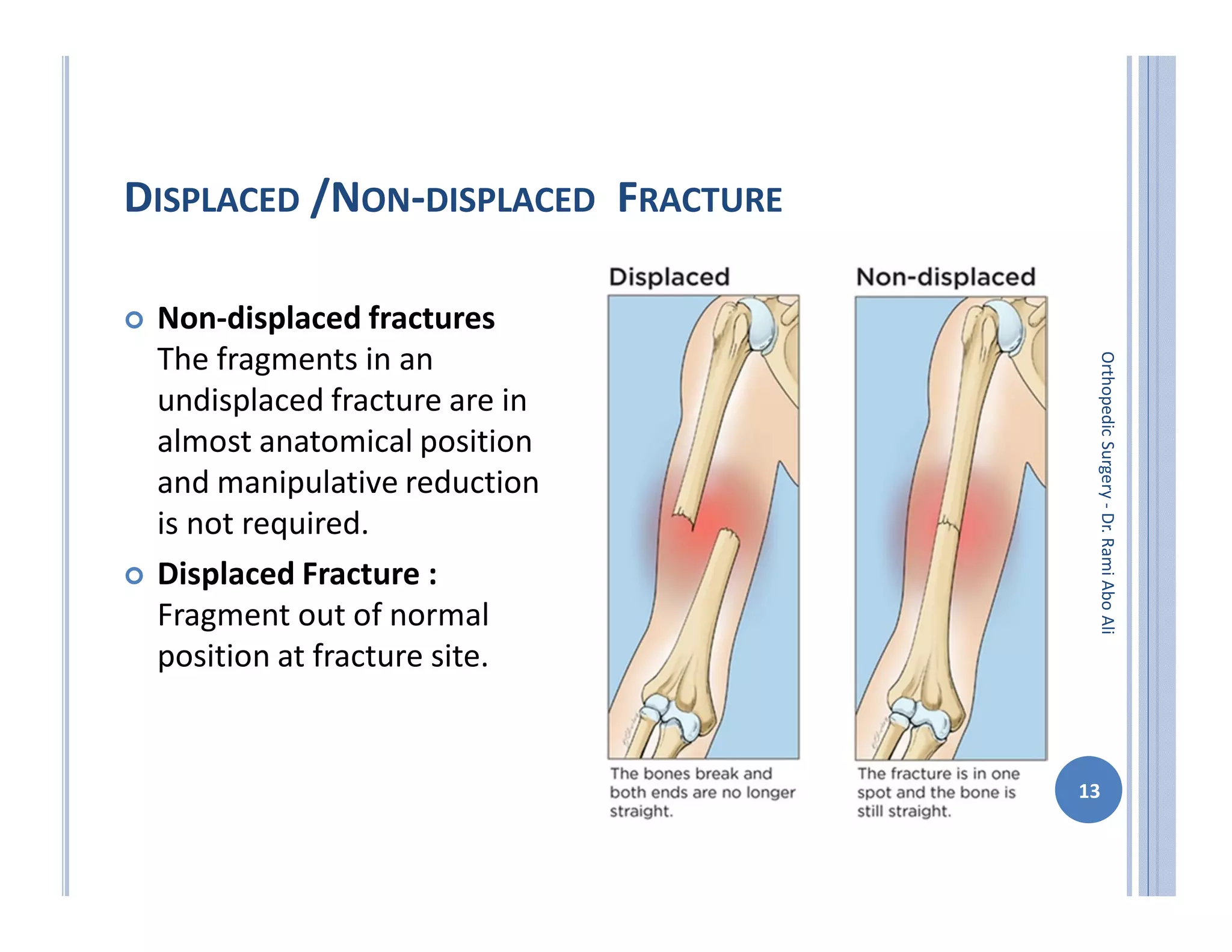 Orthopedic surgery 2nd general principles in fractures | PDF