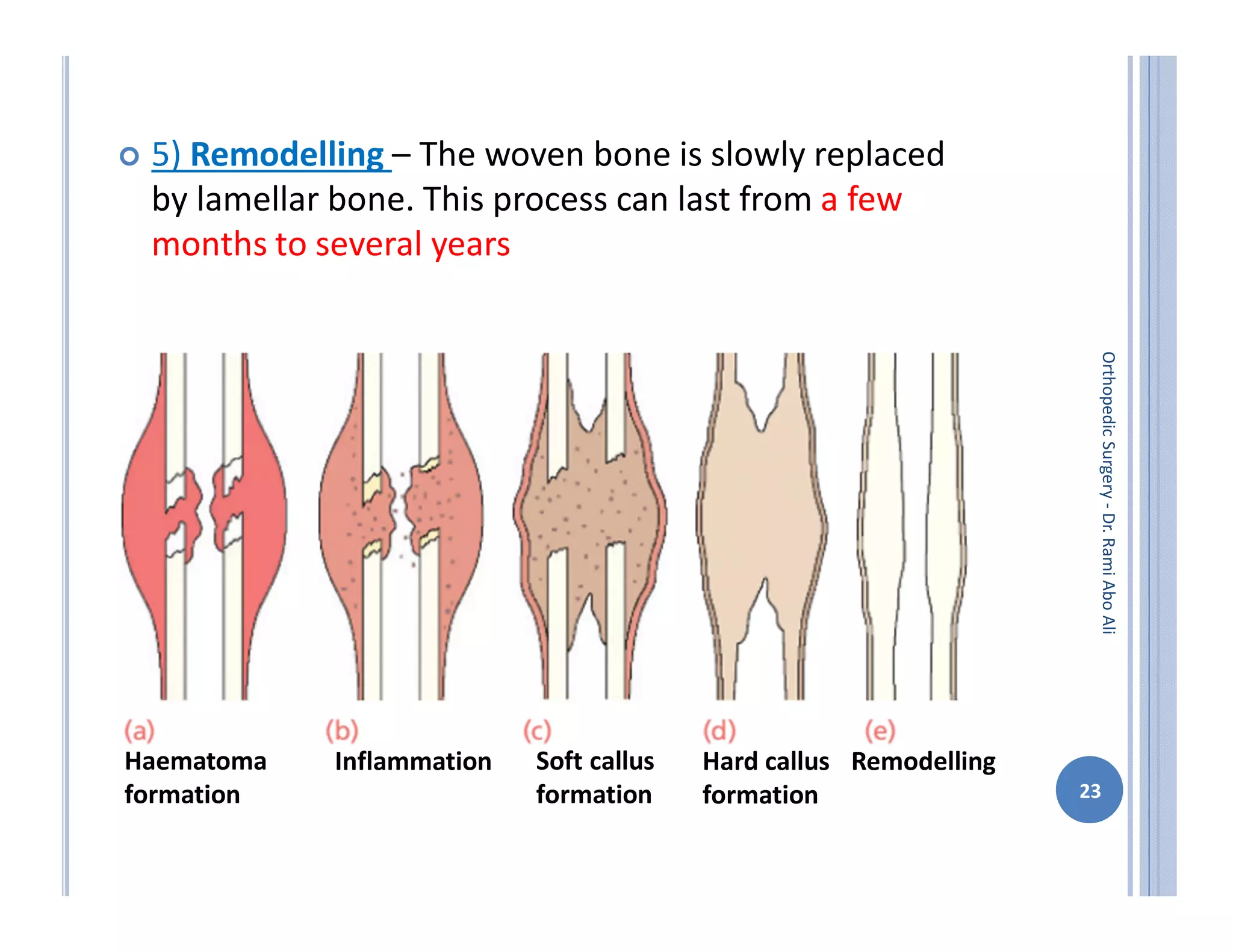 Orthopedic surgery 2nd general principles in fractures | PDF