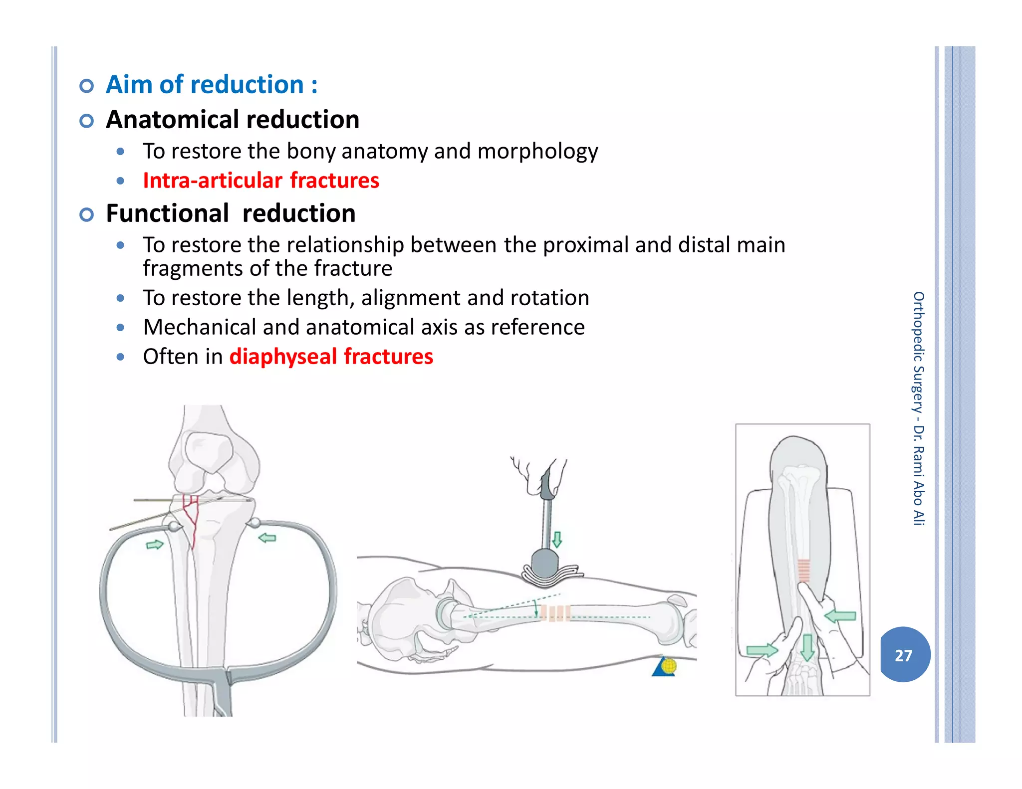 Orthopedic surgery 2nd general principles in fractures | PDF