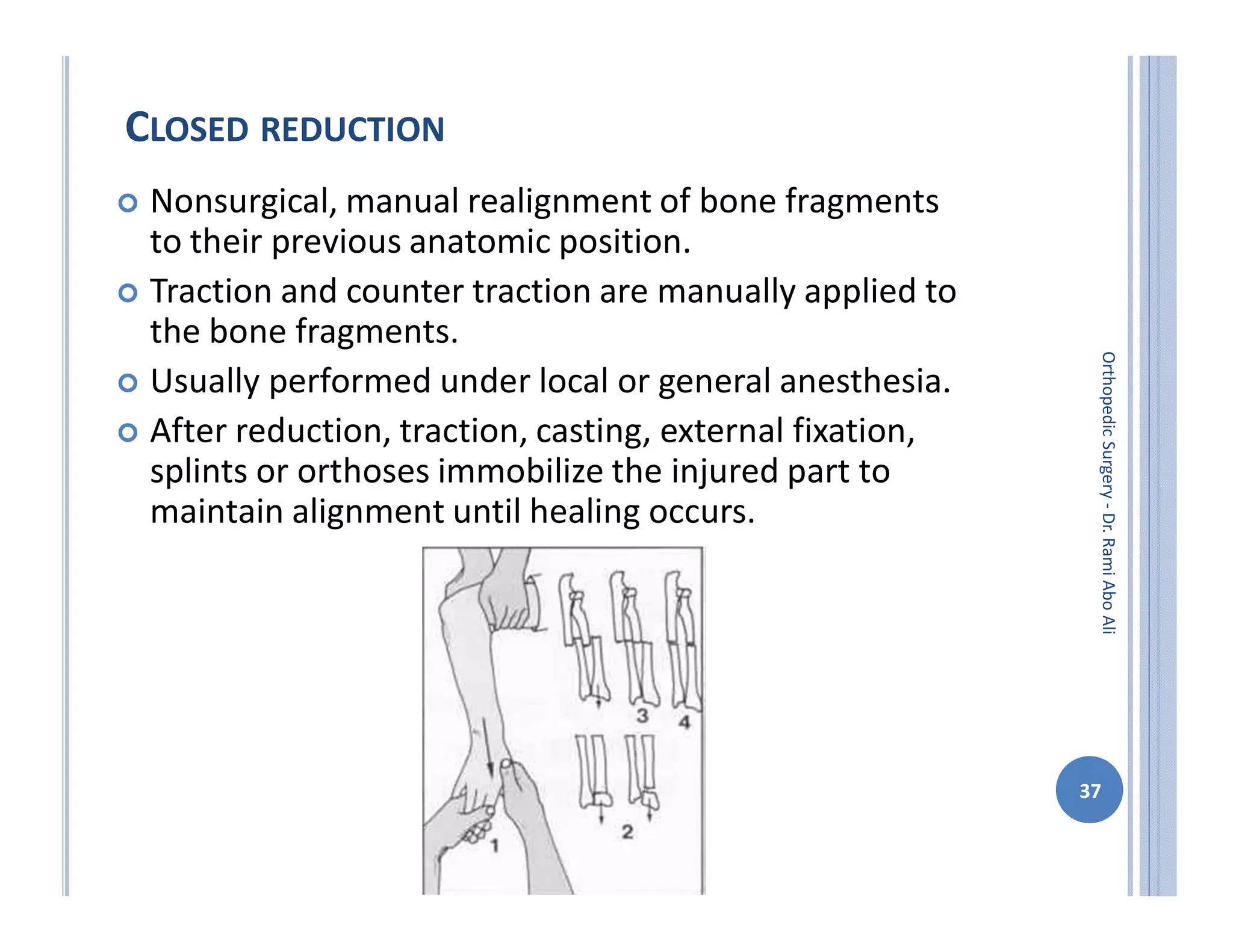 Orthopedic surgery 2nd general principles in fractures | PDF