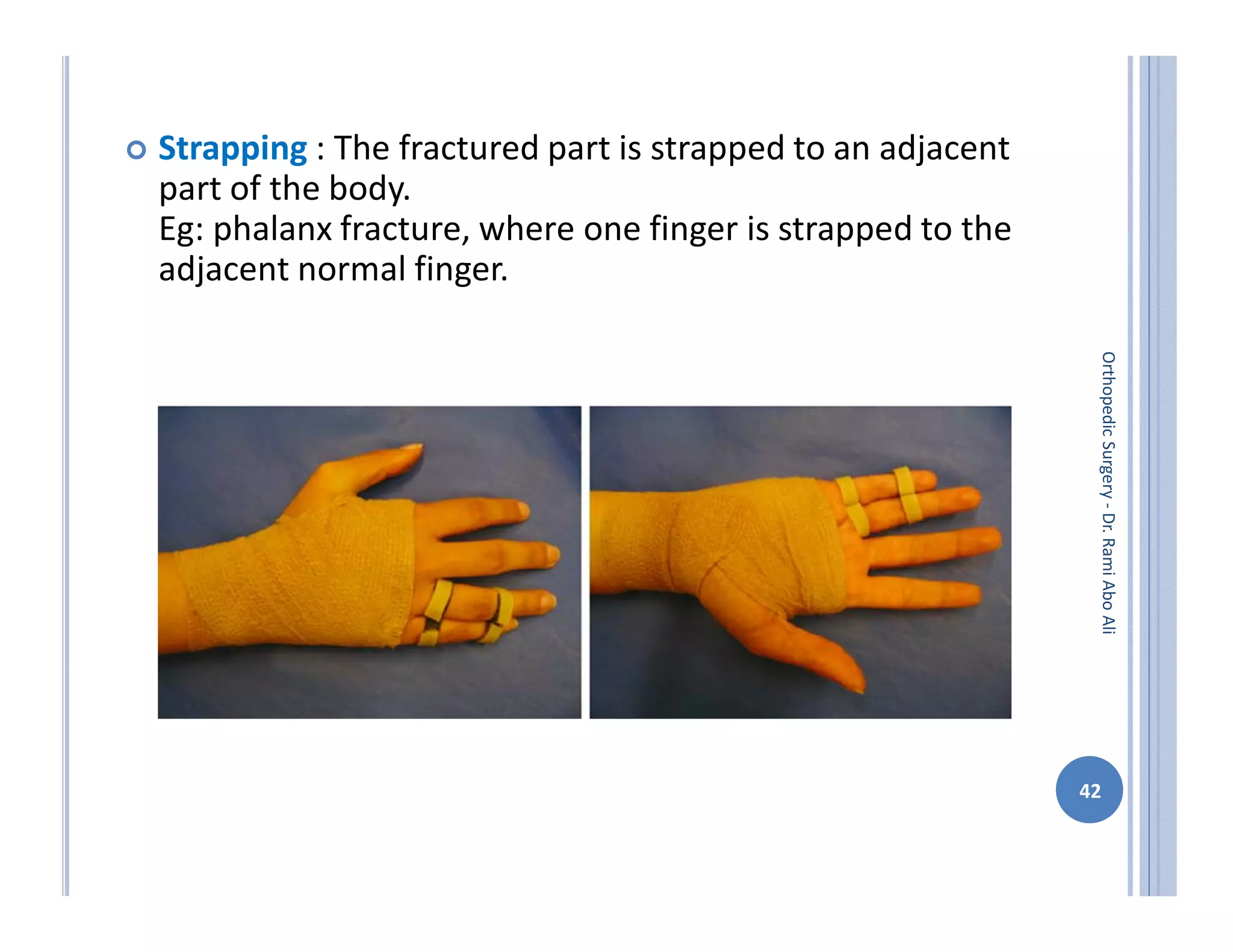 Orthopedic surgery 2nd general principles in fractures | PDF