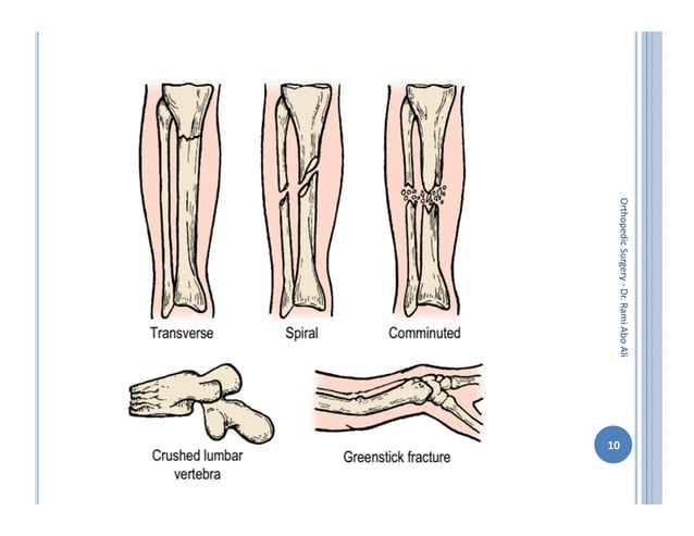 Orthopedic surgery 2nd general principles in fractures | PPT